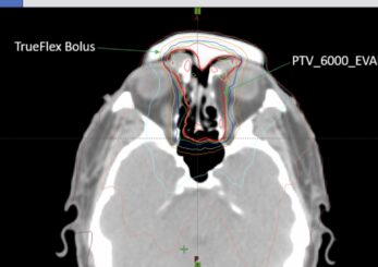University of Rochester: TrueFlex Bolus for a Malignant Neoplasm of ...