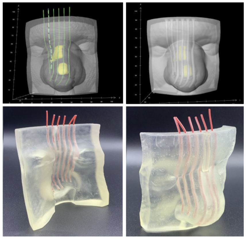 Freeman Health System: Nova Surface Brachytherapy Applicator Nose Case ...